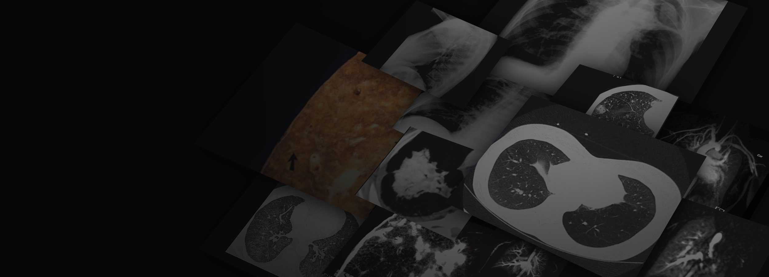Chest Imaging: Pneumonia - ESR Connect